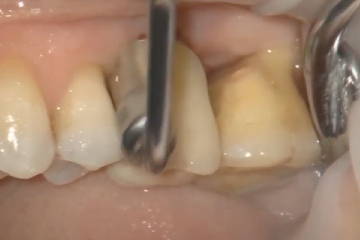 Scopri come trattare un paziente affetto da perimplantite - Discover ...