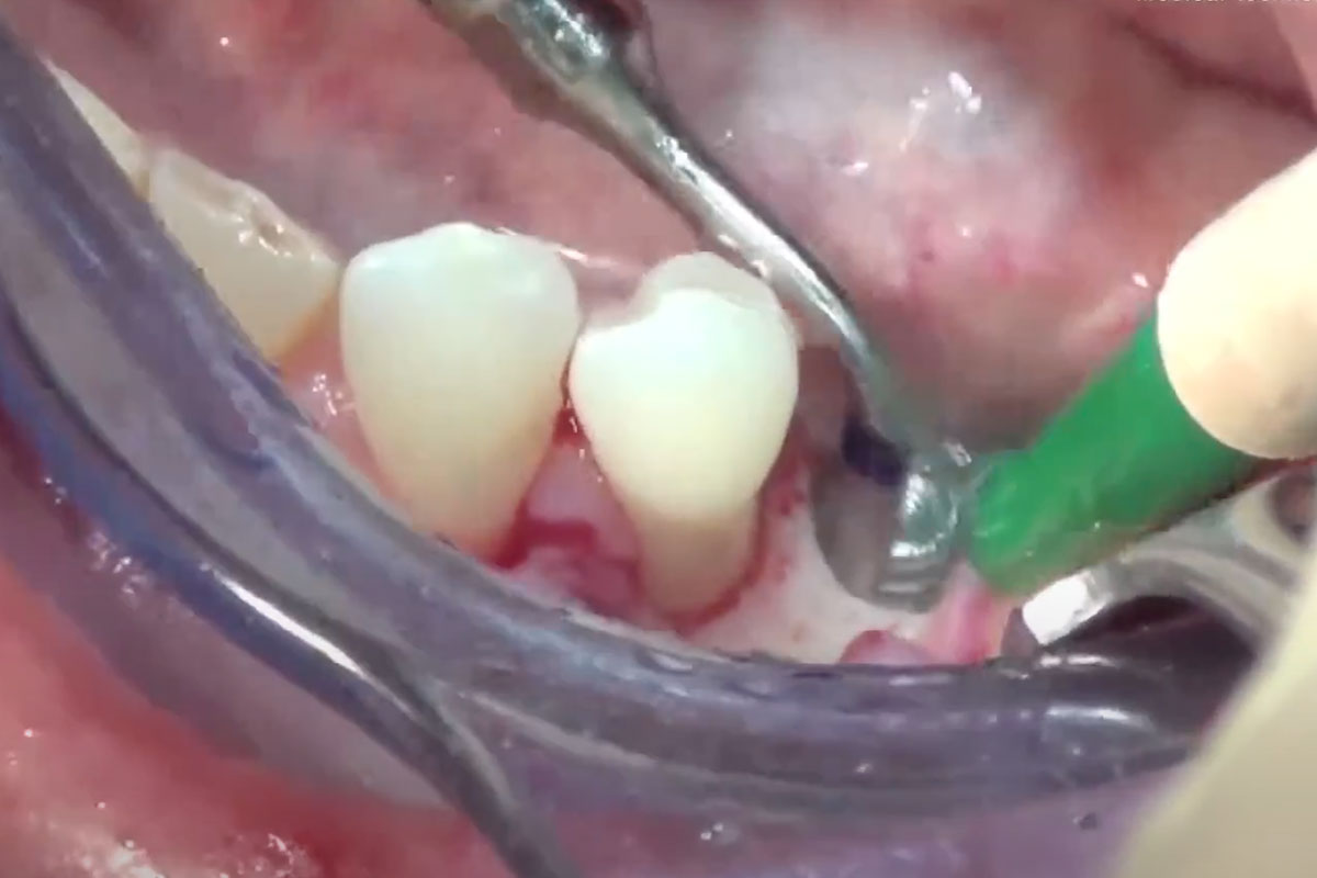 Come rimuovere un impianto con approccio chirurgico mininvasivo con ...