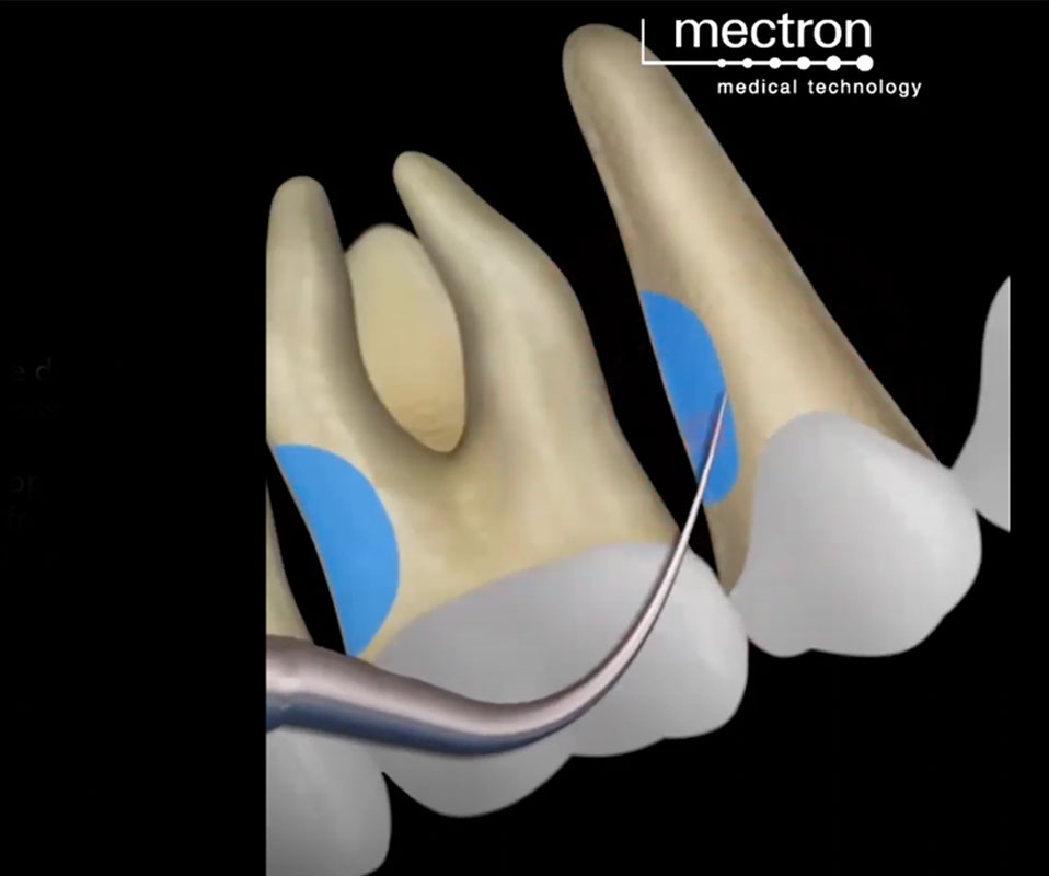 Come rimuovere efficacemente il biofilm e il tartaro nelle zone ...